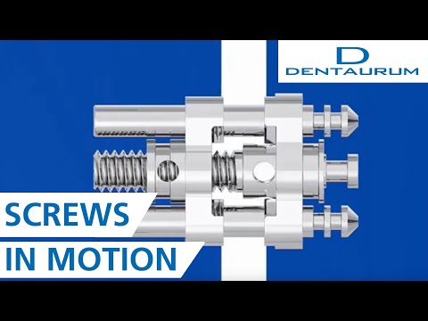 Orthodontic expansion screw in motion - YouTube