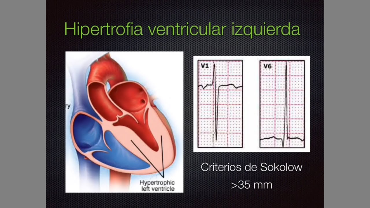 EKG patológico 3: Hipertrofia, infarto y más - YouTube