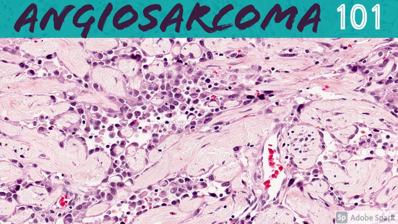 Angiosarcoma 101 (for Pathologists and Dermatologists) - YouTube