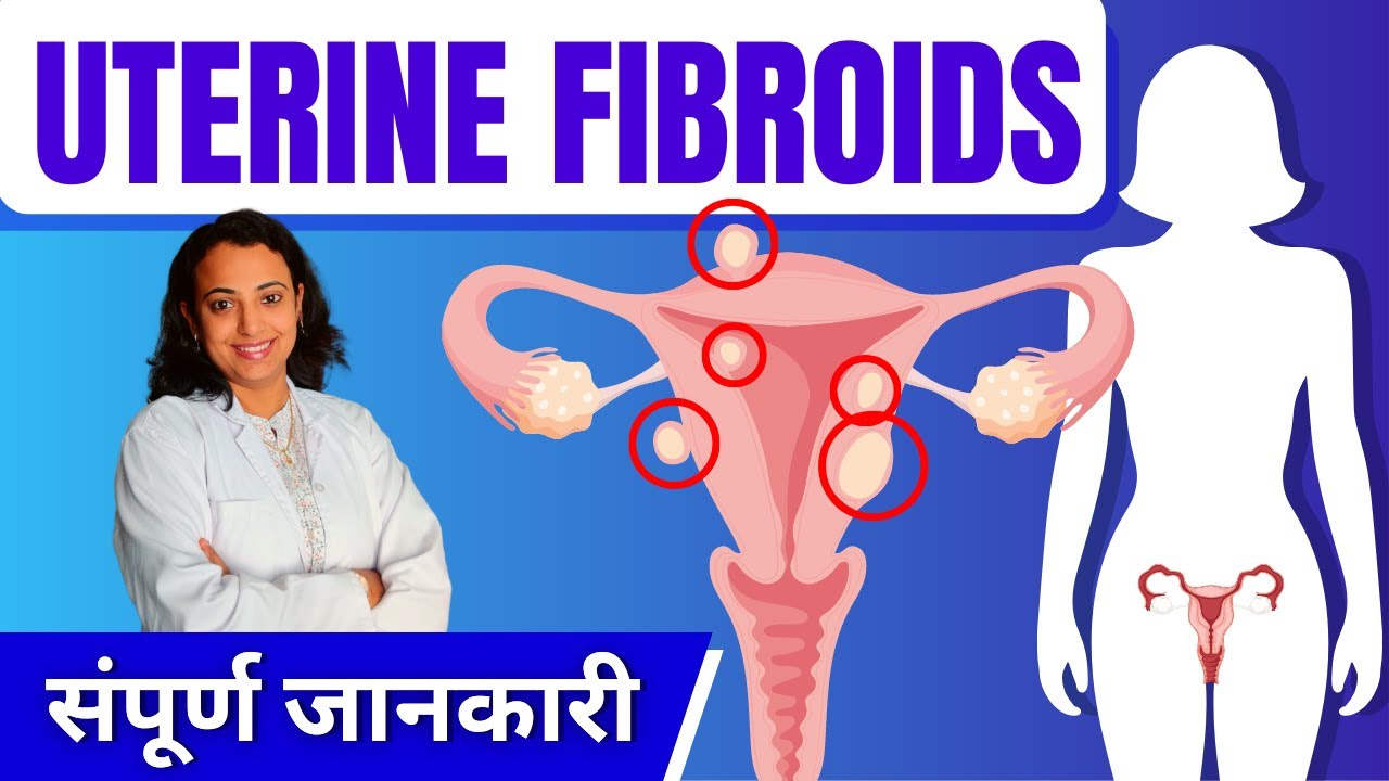 Uterine Fibroid - Definition, Risks, Symptoms, Treatment | Uterus me ...