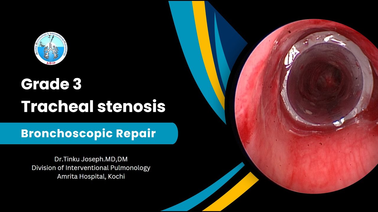 GRADE 3 POST INTUBATION TRACHEAL STENOSIS - BRONCHOSCOPIC CORRECTION ...