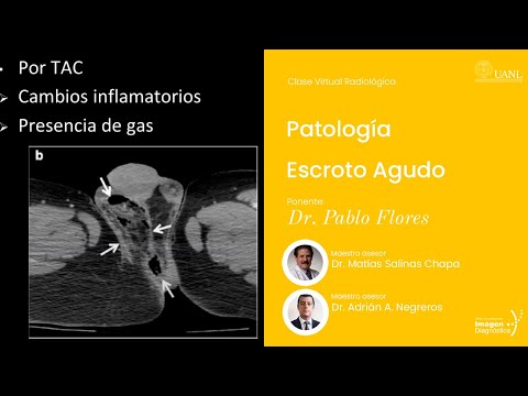 Patología Escroto Agudo Dr. Pablo Flores - YouTube