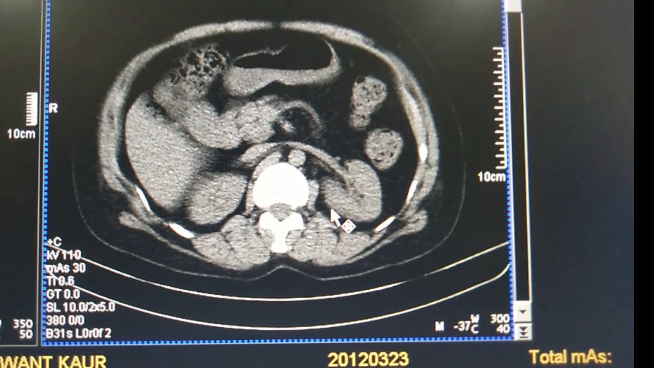 CT Peripheral Angio Teach Easy Tips || Ct Lower Limb Angio # ...