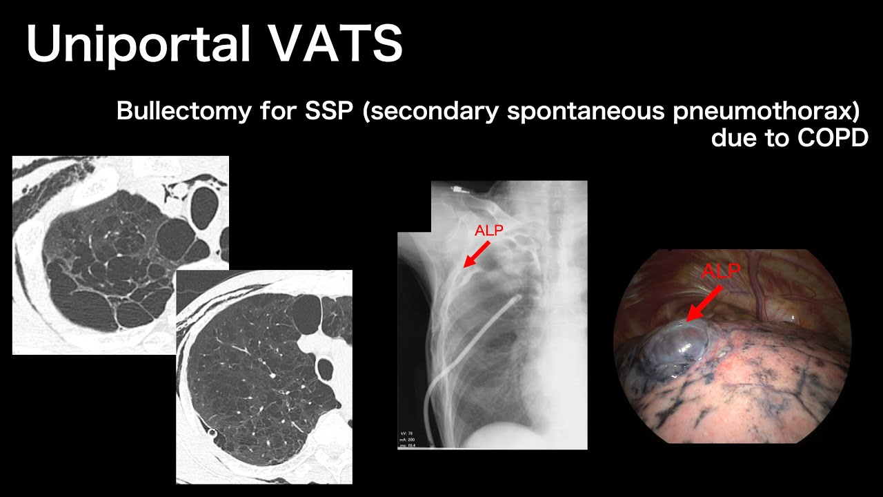 141】Uniportal bullectomy for SSP (secondary spontaneous pneumothorax ...