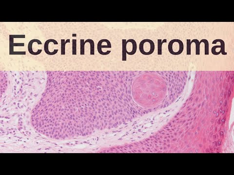 Eccrine Poroma - Pathology mini tutorial - YouTube