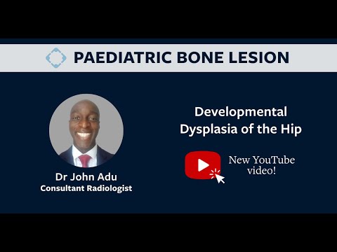 DDH - Paediatric Bone Lesions - John Adu - YouTube