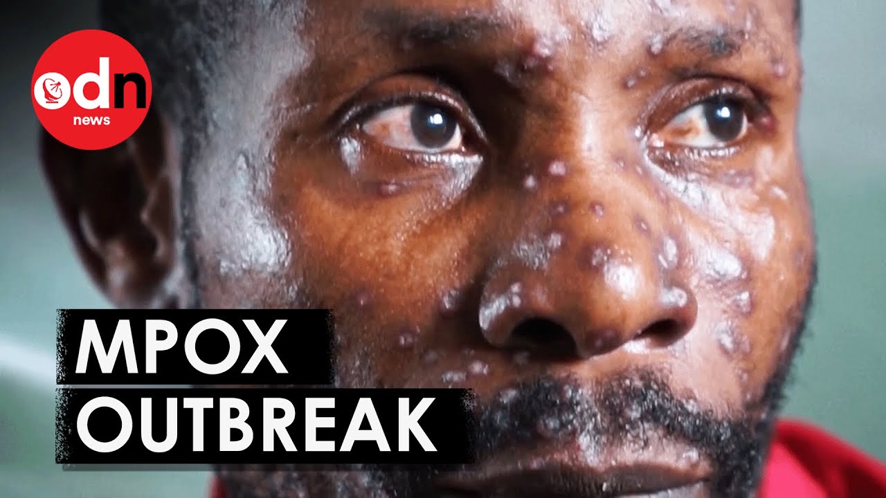 This Is What Severe Mpox Looks Like - YouTube