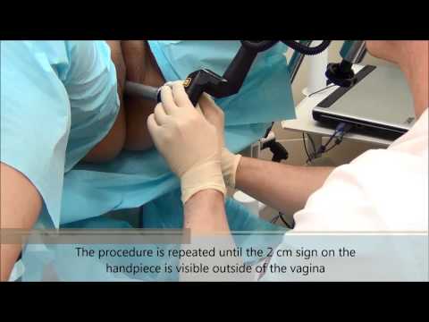 Juliet Erbium Laser - Training Video for Vaginal Tightening