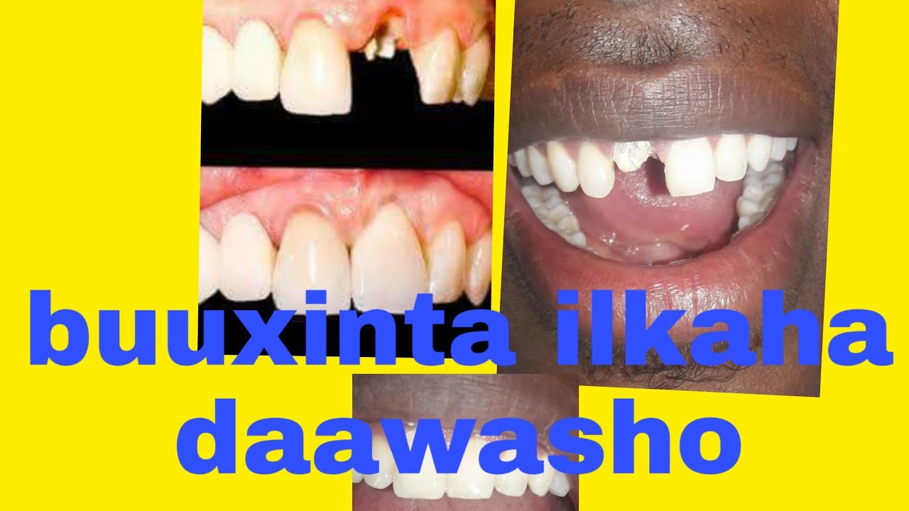 Buuxinta ilkaha kafaaideysi wacan waa markale iyo buuxinta ilkaha waa ...