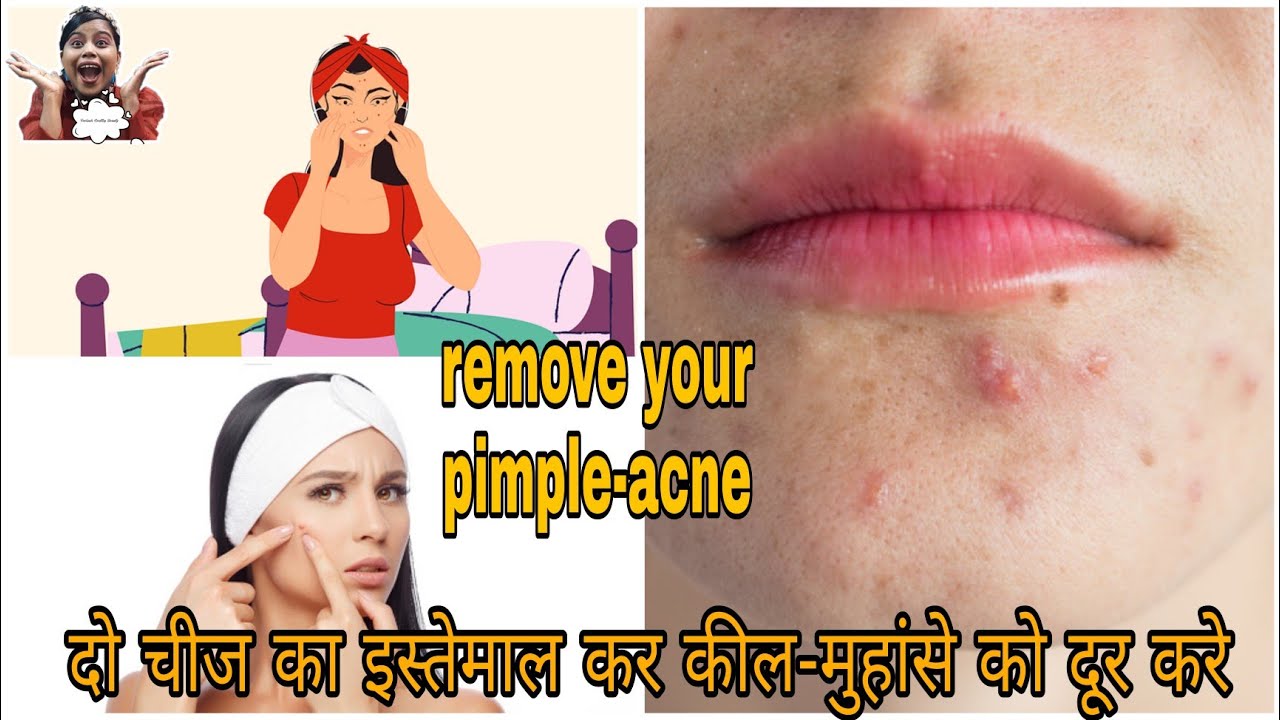 How to remove pimple,acne at home very easy steps|pimple और acne क्यों ...