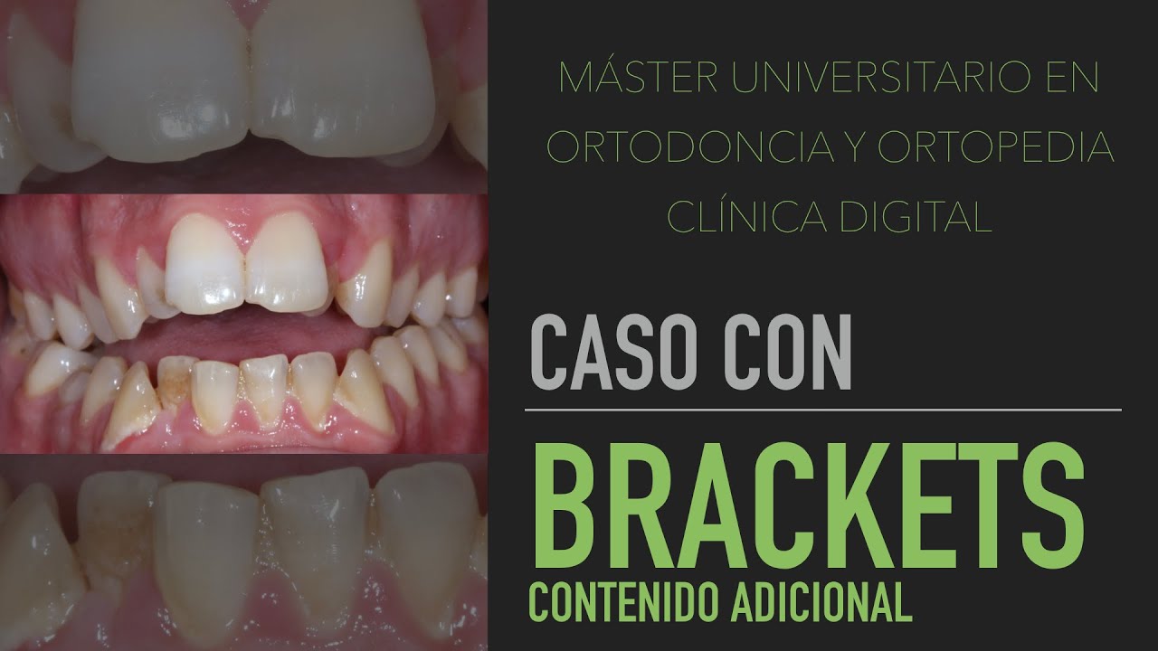 CLASE ONLINE: Caso Con Brackets (Simposio Online) - YouTube