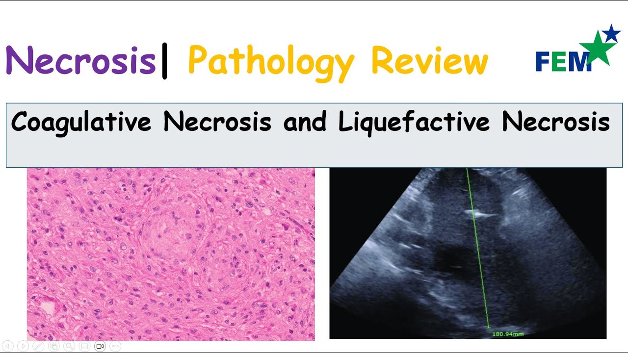Pathology Review | Necrosis | Coagulative Necrosis and Liquefactive ...