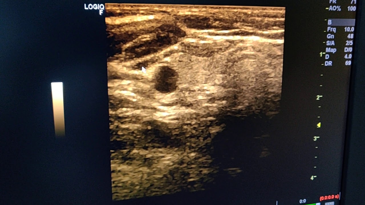 Chest wall Abscess raw(2) - YouTube