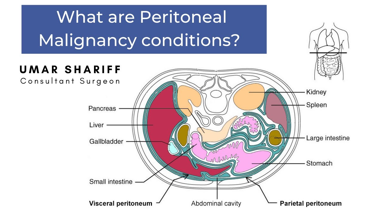 Parietal Peritoneum Location