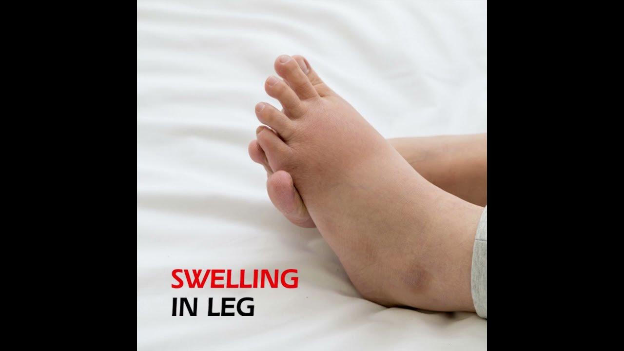 Warning Signs Of Dvt Hyderabad Vascular Center Youtube