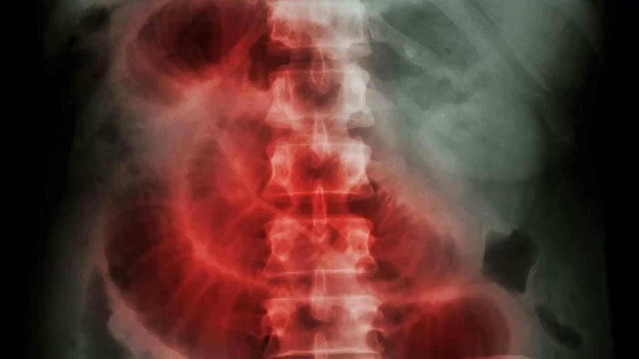 ÍLEO PARALÍTICO OCLUSIÓN INTESTINAL CAUSAS SÍNTOMAS IMÁGENES Y ...
