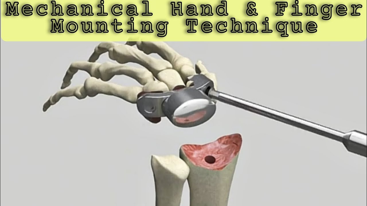 Mechanical Hand & Finger Mounting Surgical Technique-Orthopedic ...
