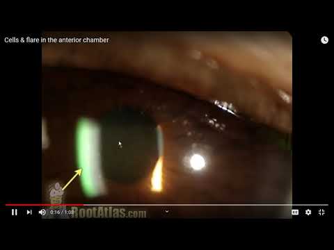 uveitis part 2 anterior cyclitis - YouTube