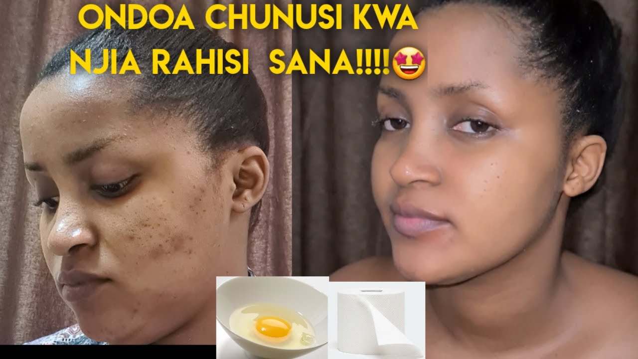 kuondoa CHUNUSI USONI na MABAKA/KWANJIARAHISI/ how to get rid of acne ...