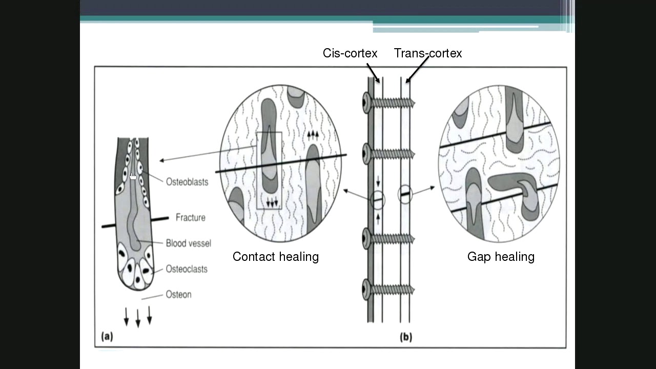 Lecture 2 Fracture healing and complications - YouTube