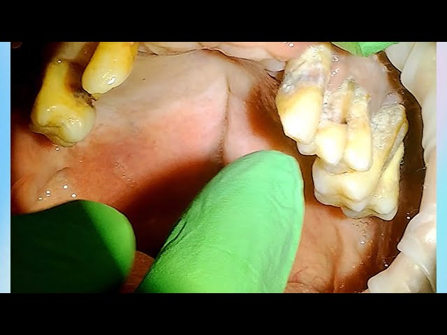 Severe Periodontal Disease With Heavy Calculus