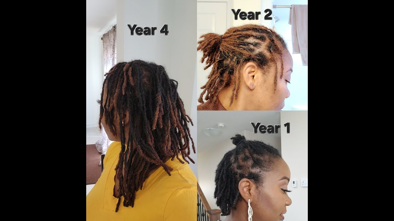 MY 4 YEAR LOC JOURNEY | HAIR LOSS | ALOPECIA TREATMENTS | CURRENT HAIR ...