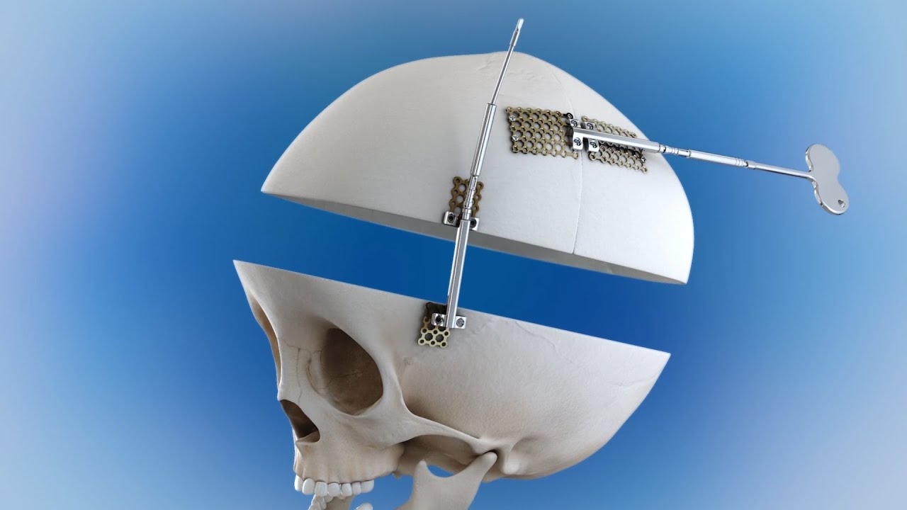 Stryker Skull Distractor Procedure Animation - YouTube