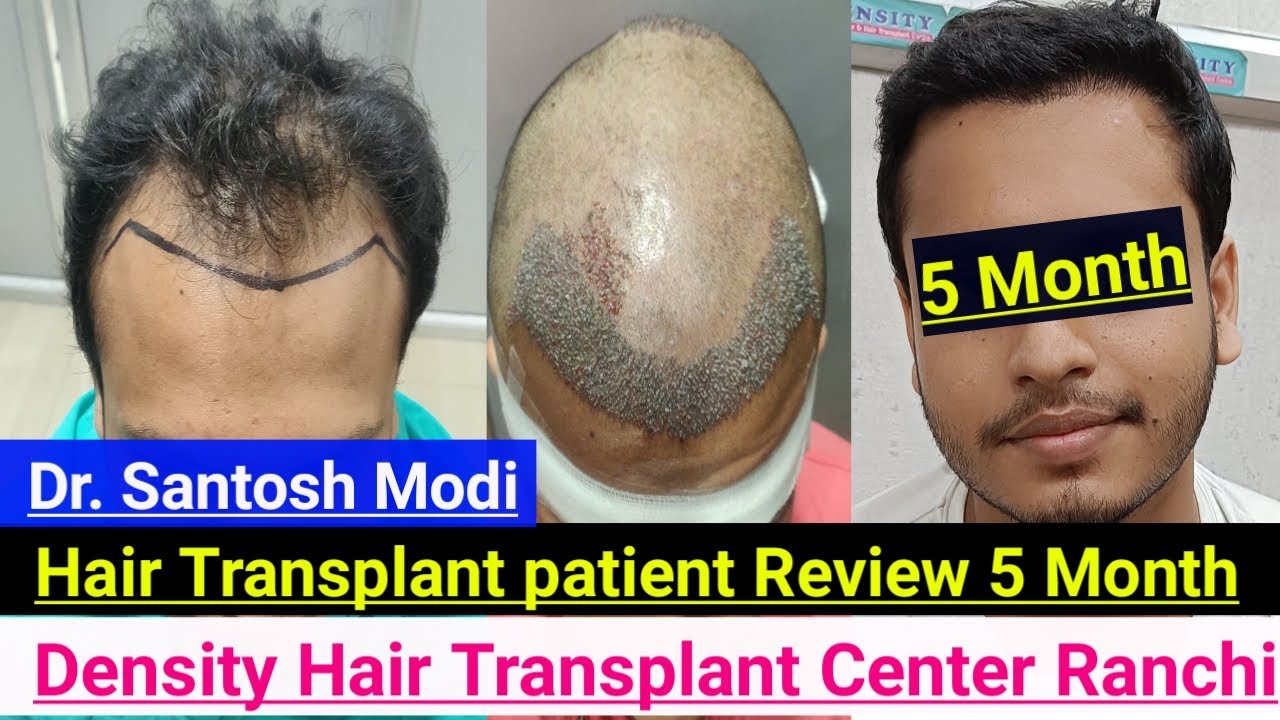 Hair Transplant Result After 5 Months | Density Hair Transplant Center ...