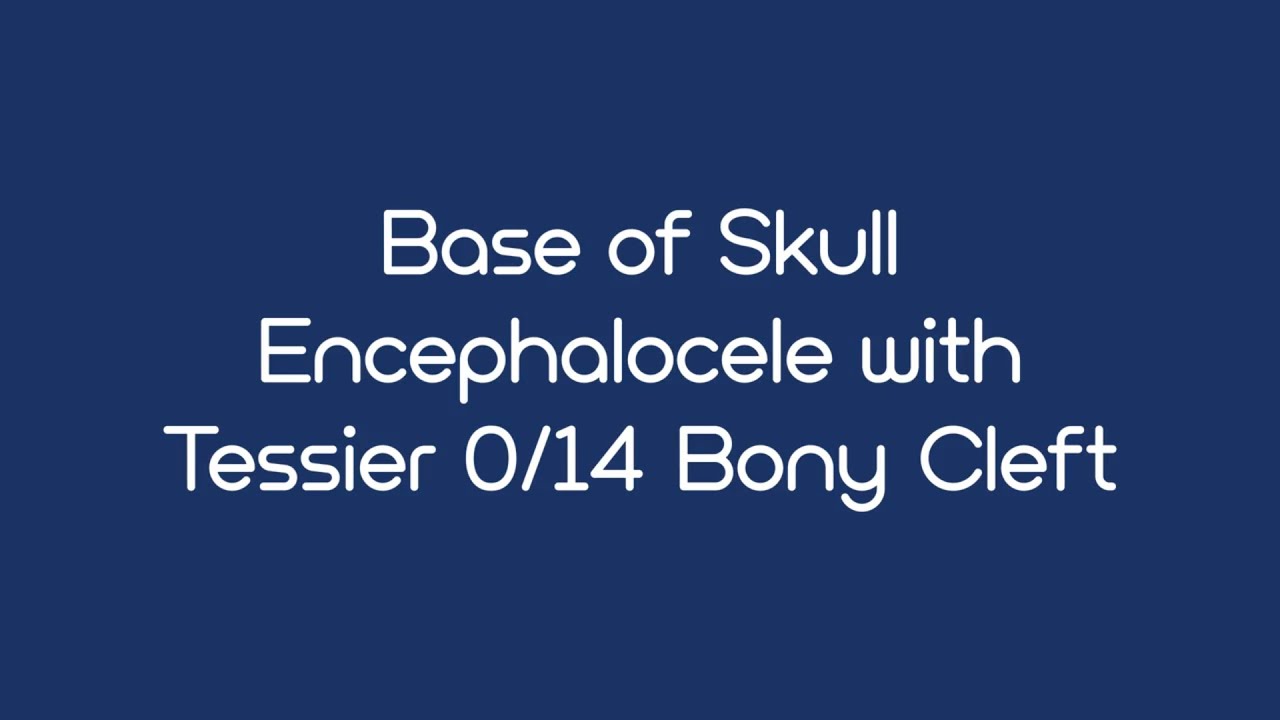 Base of Skull Encephalocele with Tessier 0/14 Bony Cleft - YouTube