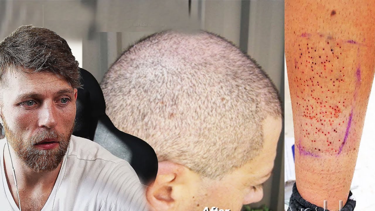 Soooo Transplanted Leg Hair Makes The Best Hair Lines? - YouTube