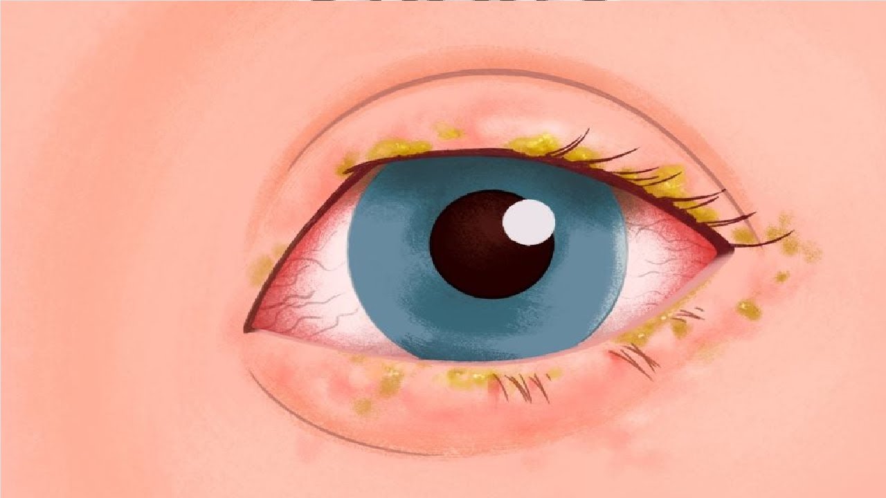 Why Do My Eyes Get Red With Contacts YouTube why-do-my-eyes-get-red-with-contacts-youtube