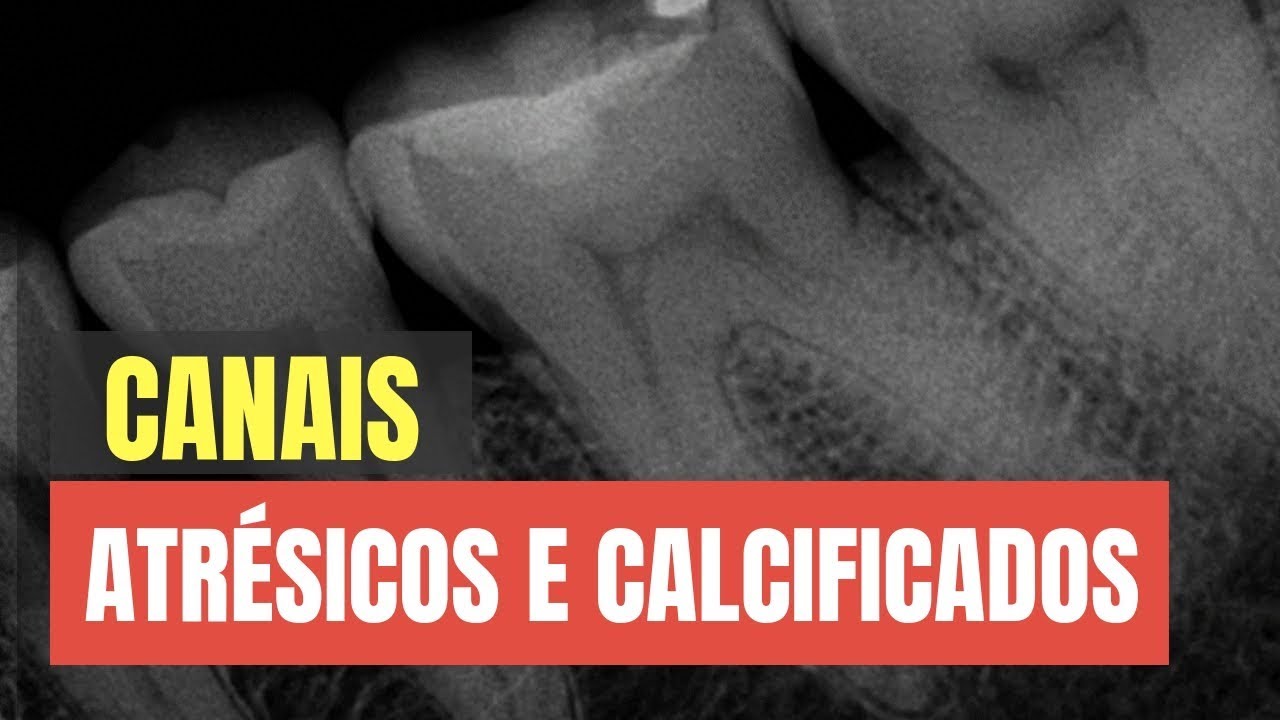 O PRIMEIRO PASSO PARA RESOLVER CANAIS ATRÉSICOS E CALCIFICADOS - QUICK ...