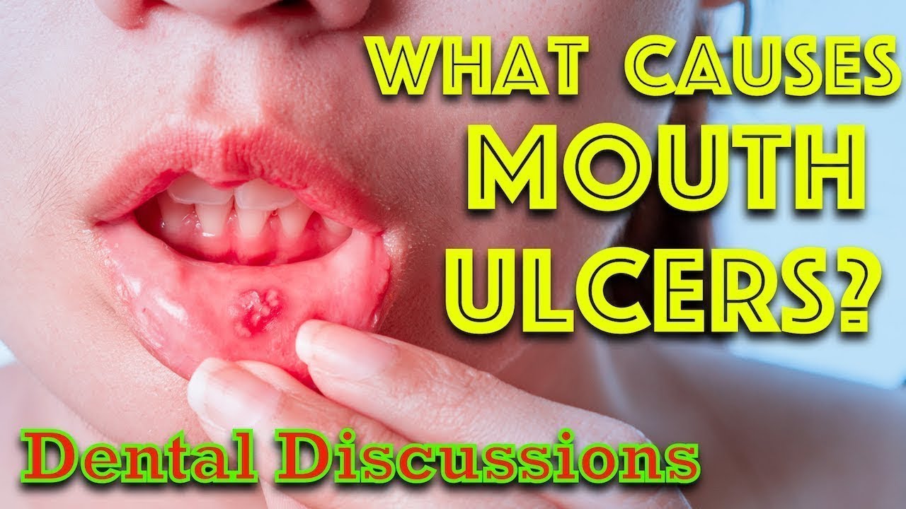 Dr Sandhya Know Your Teeth Mouth Ulcers Causes And Mouth Sores