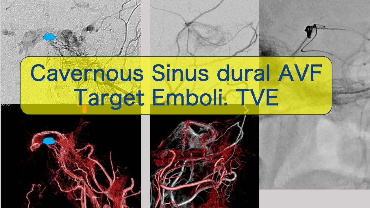 Cavernous sinus dural AVF Target Embolization, Trans-venous emboli. of ...