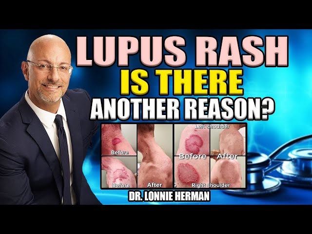 Skin Rash - Dr. Lonnie Herman - Rapid Health Recovery System for ...