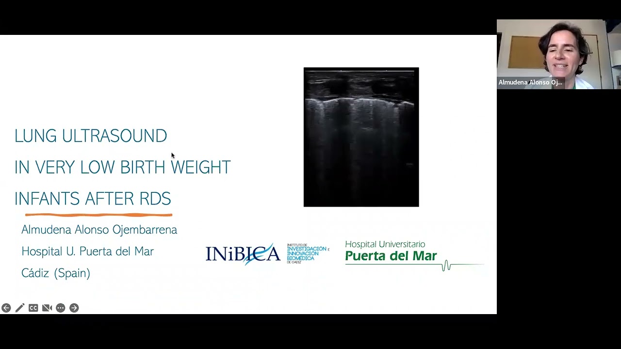 Dr Almudena Alonso - LU in preterm infants beyond RDS - YouTube