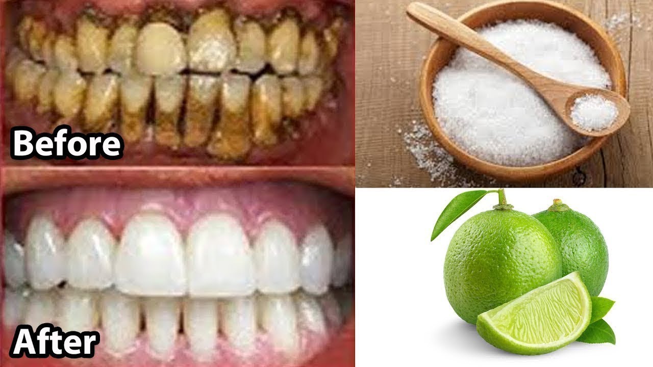 How To Whiten Teeth Naturally With Lemon and Salt In 3 Minutes At Home ...