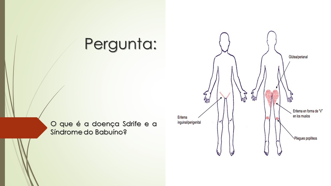O que é a doença Sdrife e a Síndrome do Babuíno? - YouTube