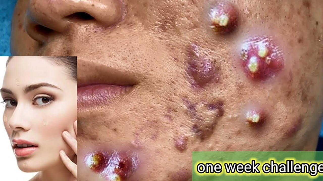 big pimple,acne treatment at home|how to remove pimple,acne,blackheads ...