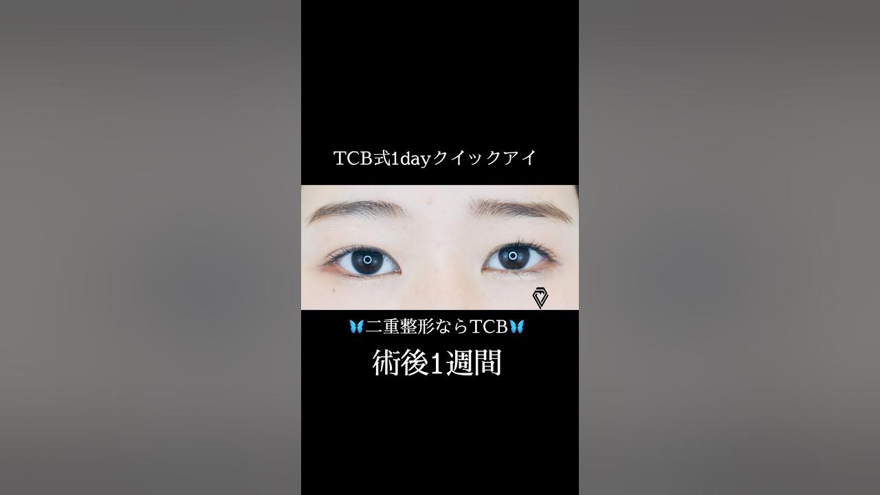 【二重整形】TCB式1dayクイックアイ（二重埋没法）術後1週間🦋 #shorts #TCB #二重埋没症例 - YouTube