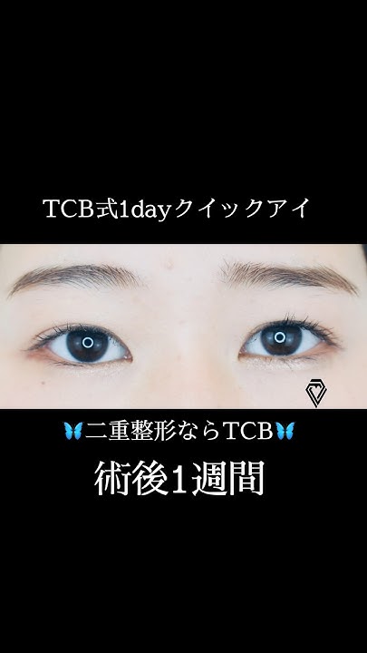 【二重整形】TCB式1dayクイックアイ（二重埋没法）術後1週間🦋 #shorts #TCB #二重埋没症例 - YouTube