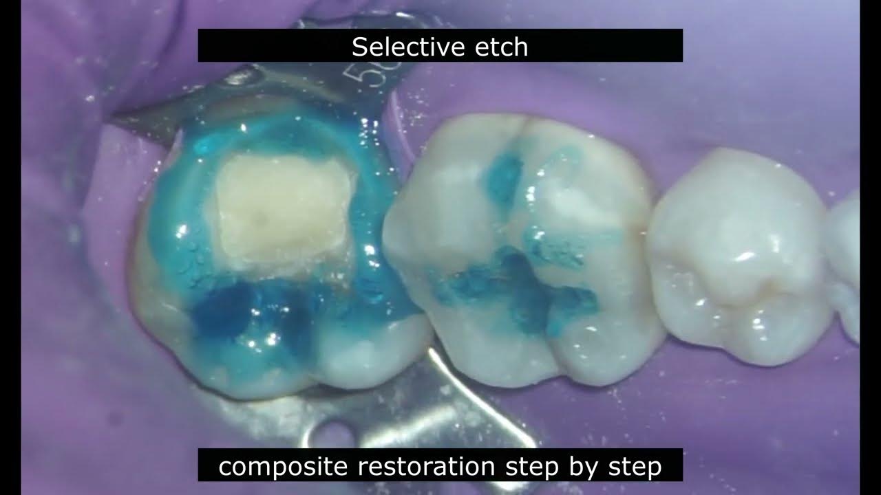 Direct pulp capping with MTA | Do watch before getting a root canal ...