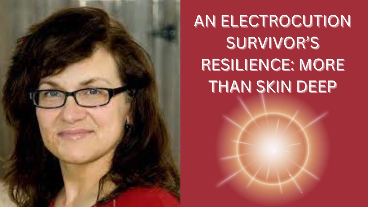AN ELECTROCUTION SURVIVOR'S RESILENCE: MORE THAN SKIN DEEP - YouTube