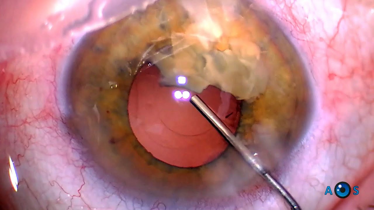 Phaco Mastery: The dense cataract under topical with posterior capsular ...