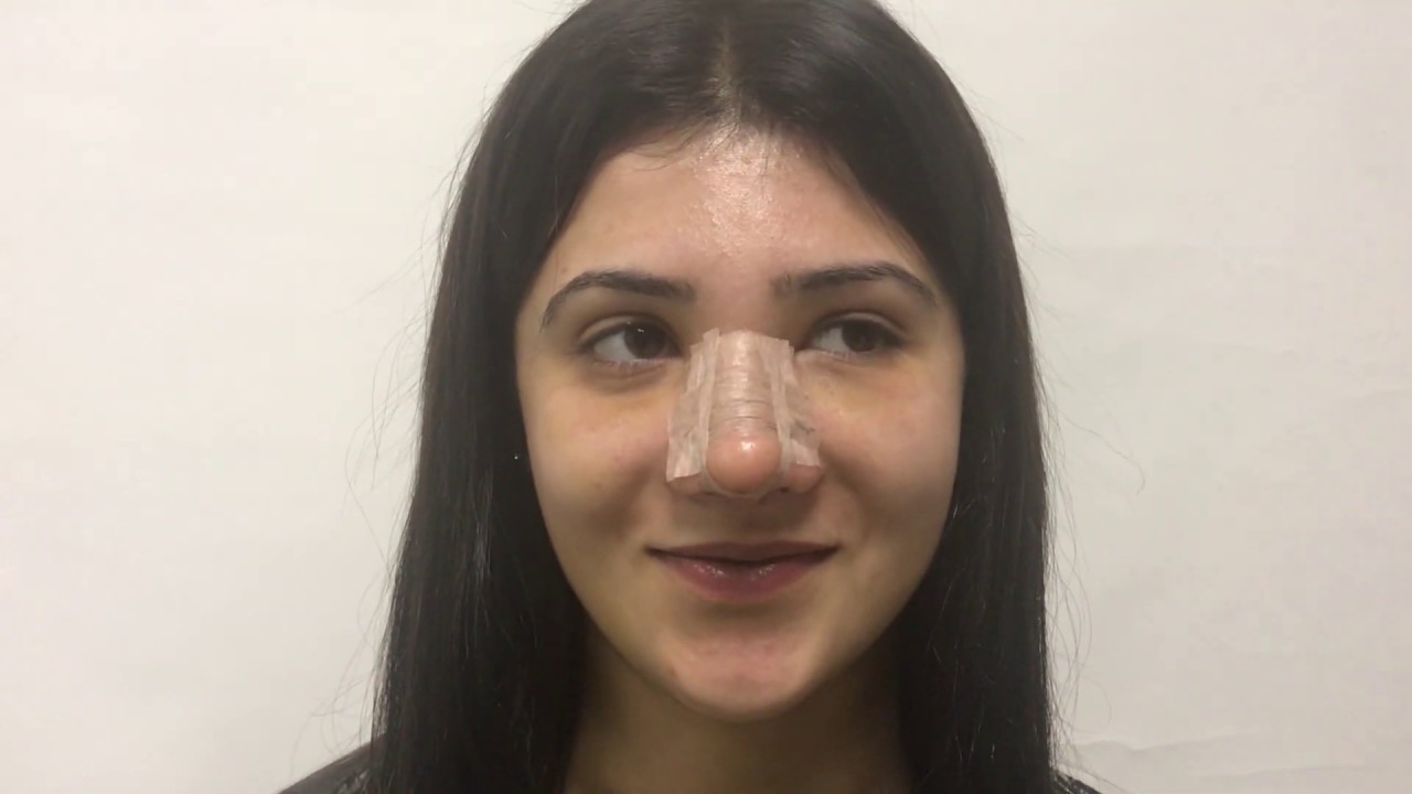 Ma Opération du nez - YouTube