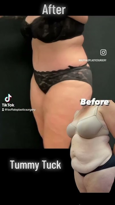 Tummy Tuck (Amazing Transformation) - YouTube