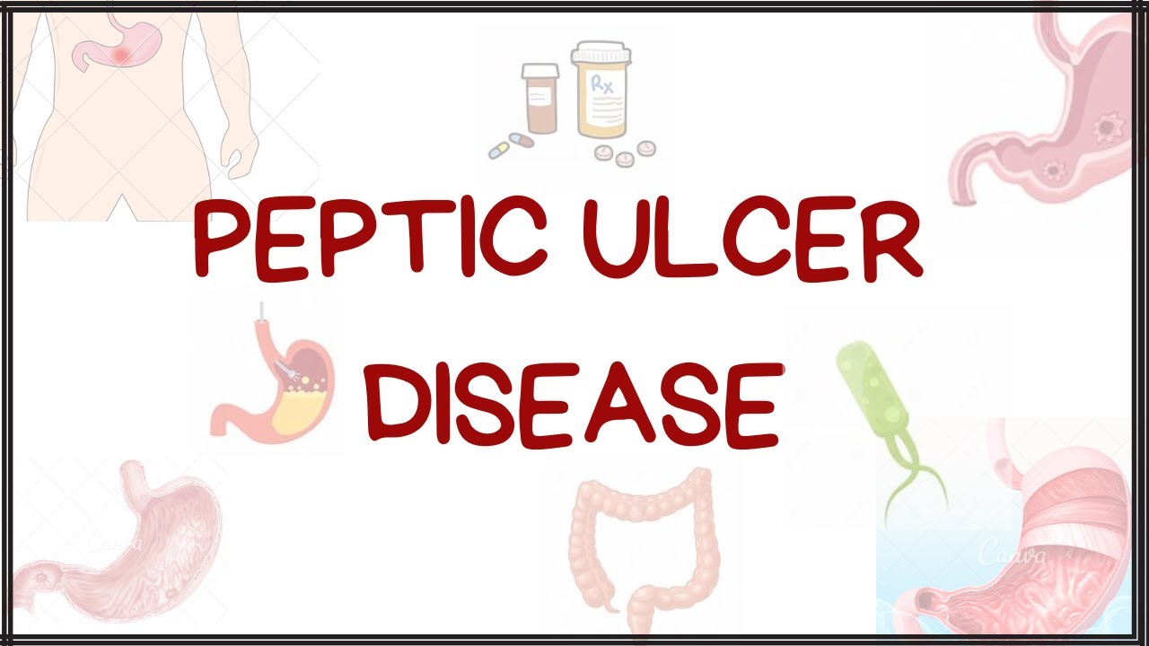 Peptic ulcers | Definition, causes, pathophysiology, symptoms ...