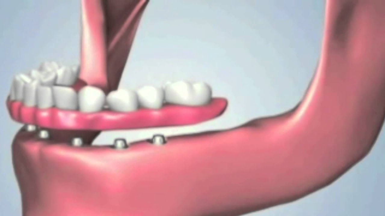 Lucrare dentara fixă pe implanturi dentare - YouTube