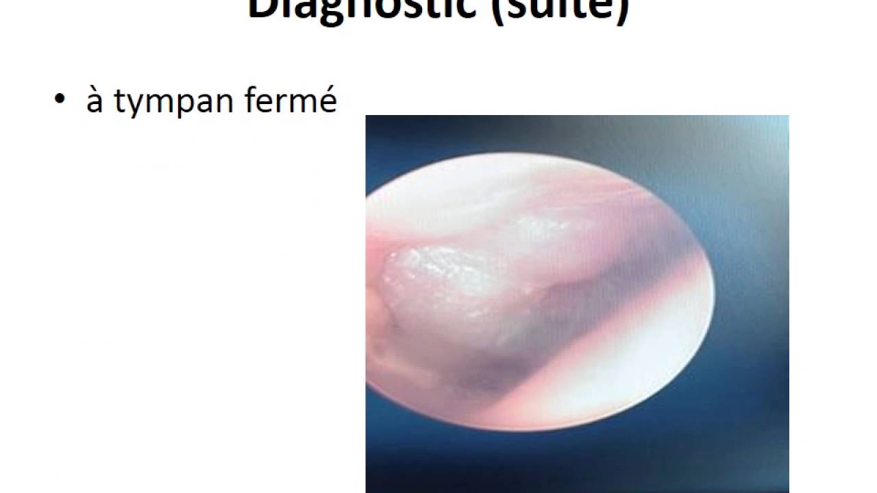 OTITE MOYENNE AIGUË - YouTube