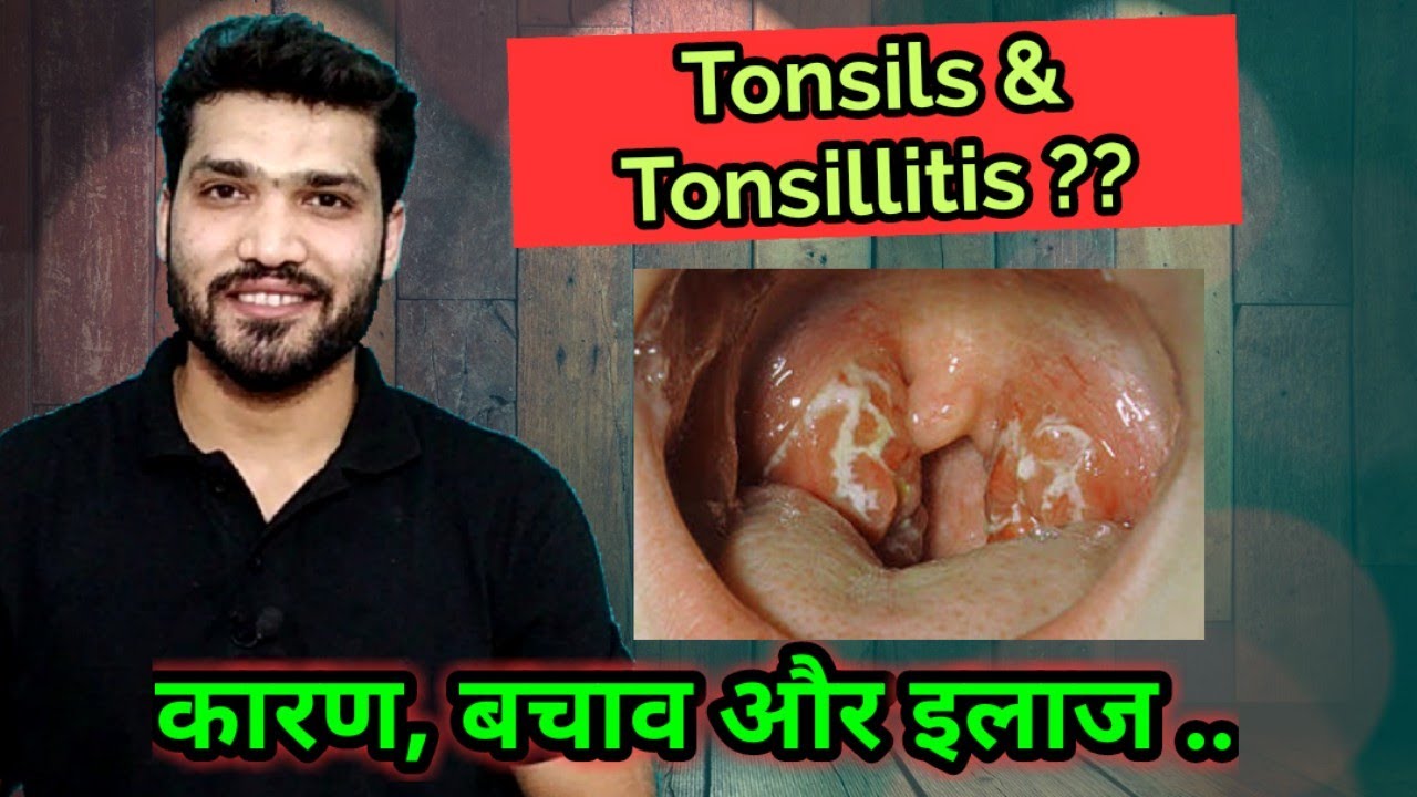 What is tonsillitis ? Prevention & treatment - YouTube